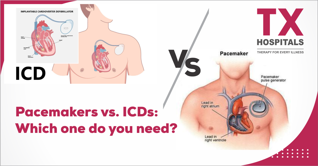 Pacemakers vs. ICDs: Which One Do You Need?